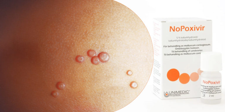Så kan du enkelt bli kvitt mollusker och dess besvär – genom NoPoxivir – Unimedic Pharma